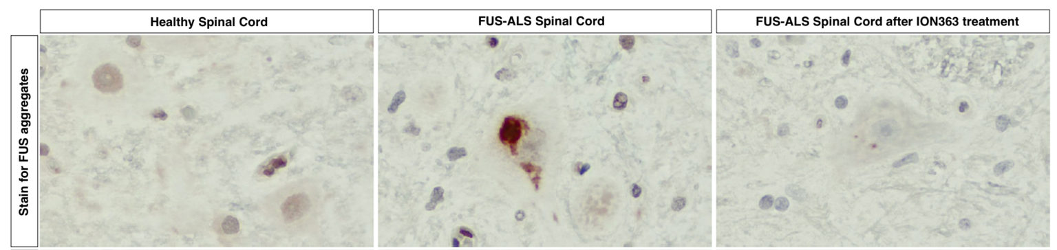 New Model and Gene Targeting Approach Show Promise for ALS Therapies ...